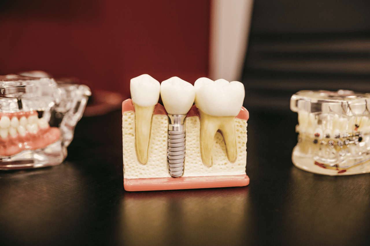 Single Tooth Replacement in Spring, Texas | Tooth replacement